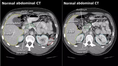 Liver Segment Anatomy Ct Scan Pptx Digestive Disorders Diseases And Conditions