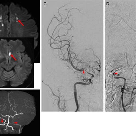 Figure2 Brain MRI MRA And Selective Angiography A Diffusion Weighted