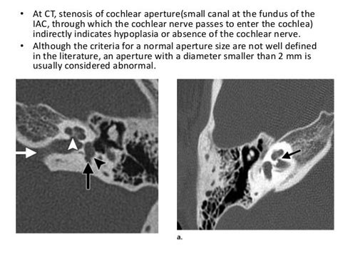 Preoperative Assesment In Cochlear Implantation