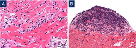 A Ischemic Injury Coagulative Myocyte Necrosis With Mixed