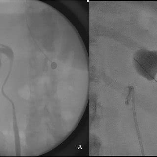 Retrograde Pyelogram A Performed Via Ureteral Access And Antegrade Download Scientific