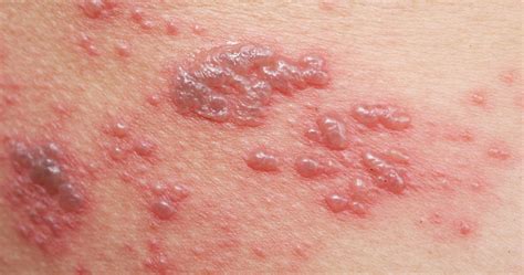 This Is What Shingles Actually Are And Here Is The Simplest Way To
