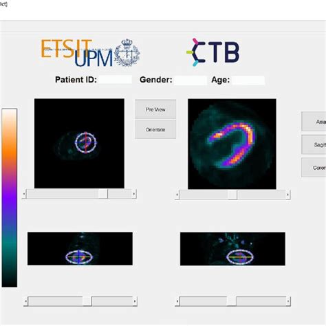 Segmentation Module Showing The Localized And Segmented Left Ventricle