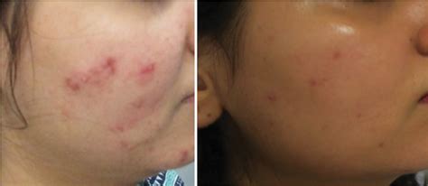 Tips For Managing Post Inflammatory Hyperpigmentation Of Acne Cosmoderma