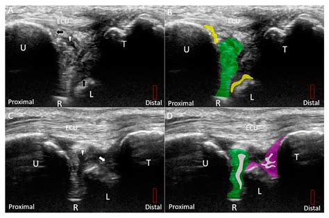 Wrist Ligament Ultrasound