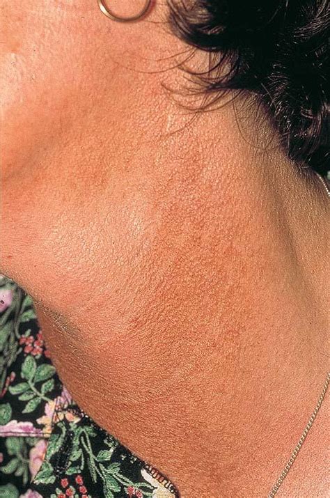 Poikiloderma Of Civatte