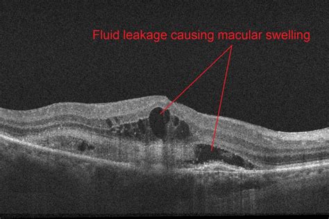 Age Related Macular Degeneration Treatments Retina Doctor Melbourne