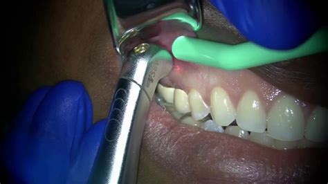 Video Fred Barnett On Linkedin Biolase Iplus Ercrysgg Laser For