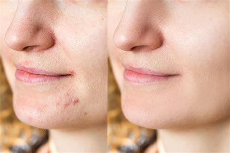 Cómo eliminar un grano de la cara rápidamente Todos los trucos para