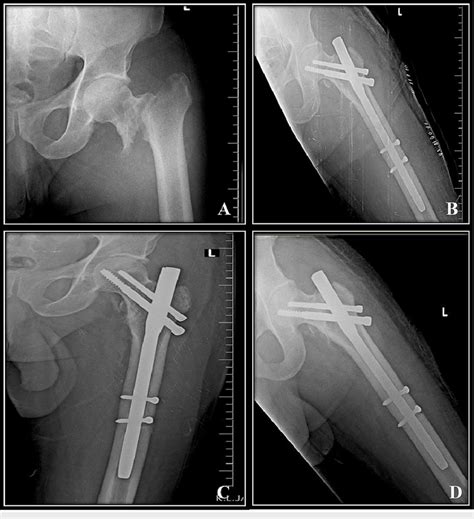 Pre Operative And Post Operative Follow Up Radiographs Of An