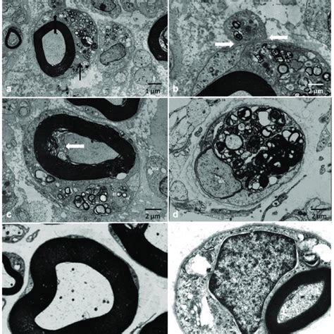 Pathological Alterations In Different Reported Cohorts Of Cidp