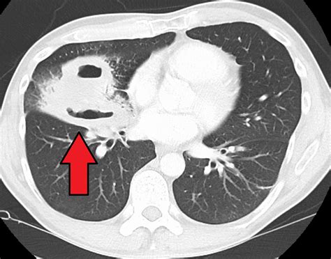 Lung Abscess Abscess Pulmonary