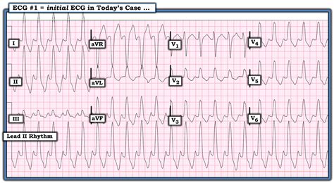 Vt Or Supraventricular Tachycardic Rhythm With Aberrancy Dr Smith