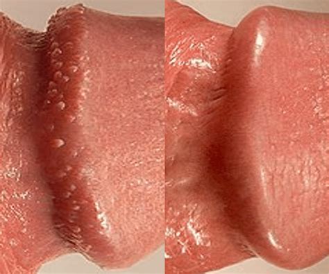 Traitement De La Couronne Perl E Du Gland Boutons Sur Le Gland Du P Nis