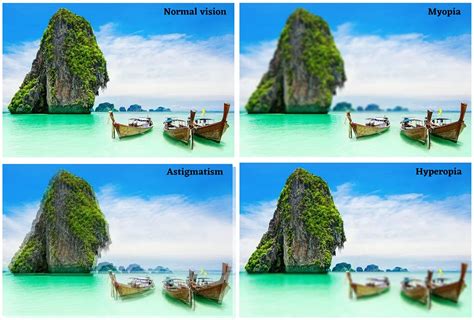 Myopia Hyperopia Astigmatism