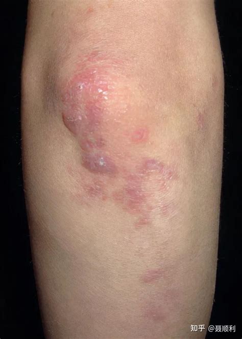 熟悉皮肌炎的皮肤改变，少一些误诊（上） 知乎