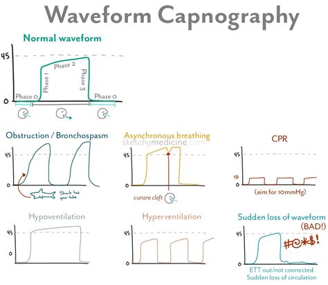 End Tidal Co2 Monitoring Waveforms Maranda Juarez