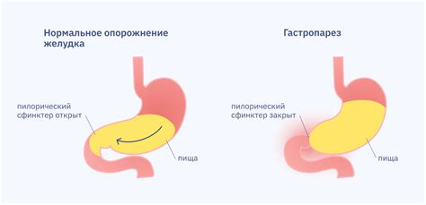 Гастропарез | Купрум
