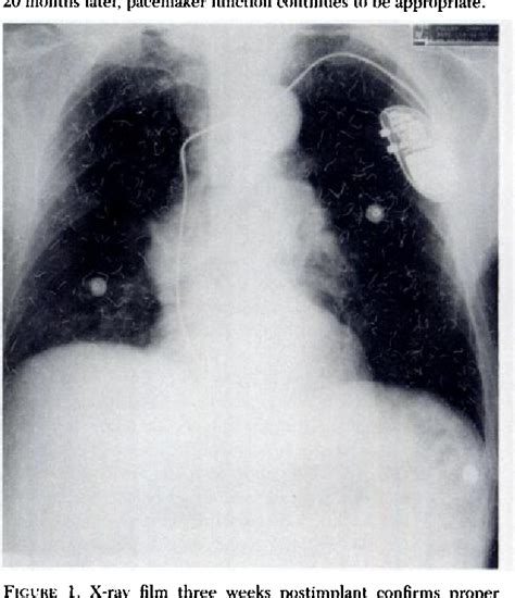 Figure 1 From Aggressive Pacemaker Twiddlers Syndrome Dislodgement Of