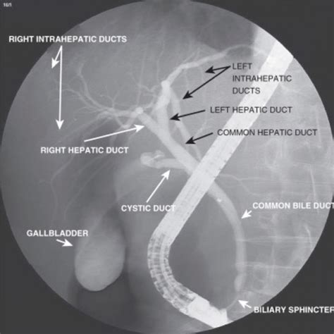Diagram Of Biliary Tree