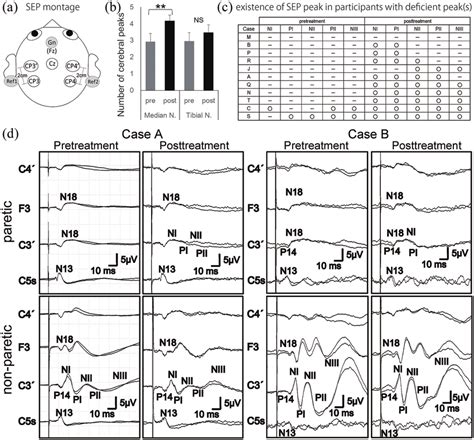 Features Of Somatosensory Evoked Potentials Pre And Post Treatment Download Scientific Diagram