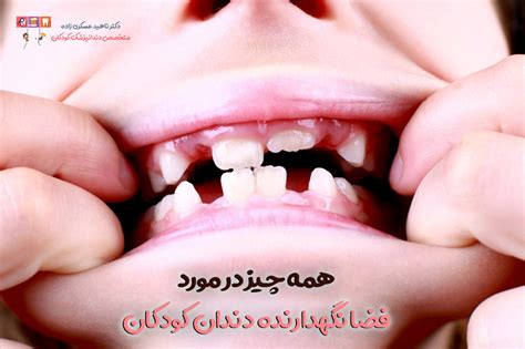 همه چیز در مورد فضا نگهدارنده دندان کودکان كلينيك دكتر ناهيد عسكری زاده