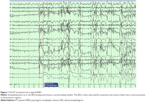 Long Term Video EEG Monitoring For Diagnosis Of Psychogenic Nonep NDT