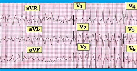 Ecg Interpretation Ecg Blog 135 Regular Wct Fascicular Vt Rbbb