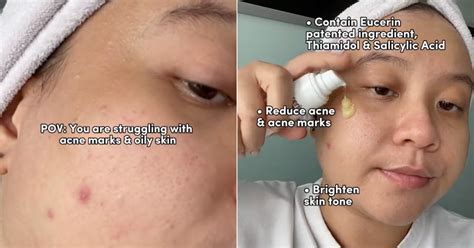 “my Acne And Acne Marks Are Slowly Fading” Msians Share Reviews Of Eucerins Acne Range Life