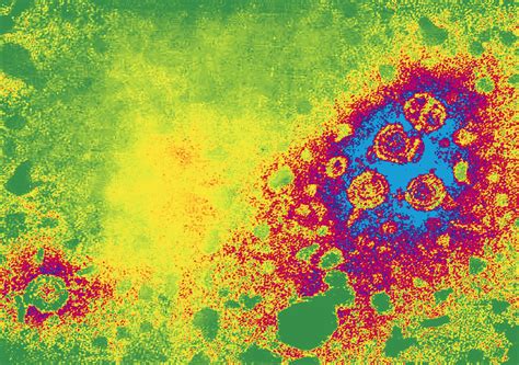 Cholangiocarcinoma The Bile Duct Cancer With A Low Survival Rate