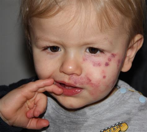 Angiome Plan Bébé Journal Dune Naturopathe