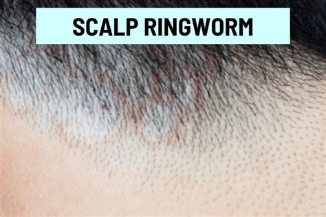 Red Spots On Scalp Causes Pictures And Treatment