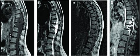 A T1 Weighted Sagittal Magnetic Resonance Imaging Mri Shows A