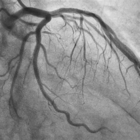 Percutaneous Transluminal Coronary Angioplasty Ptca