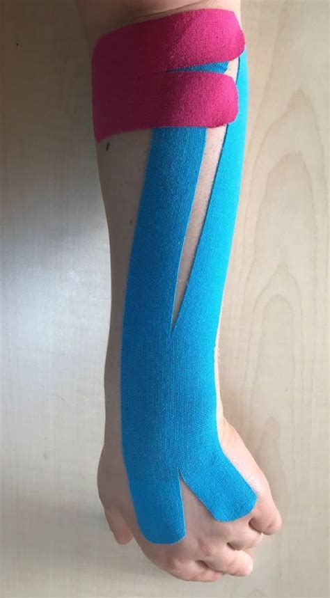 Bracing Or Kinesio Taping In The Management Of Lateral Elbow Tendinopathy A Prospective