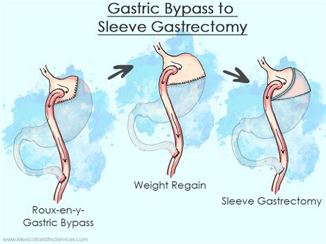 16 Revision Bariatric Surgery In Mexico Medical Tourism Co