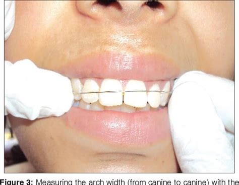 Figure 1 From Four Odontometric Parameters As A Forensic Tool In