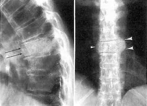 Quotminquot Vertebral Hemangioma Vertebral Angioma Symptoms