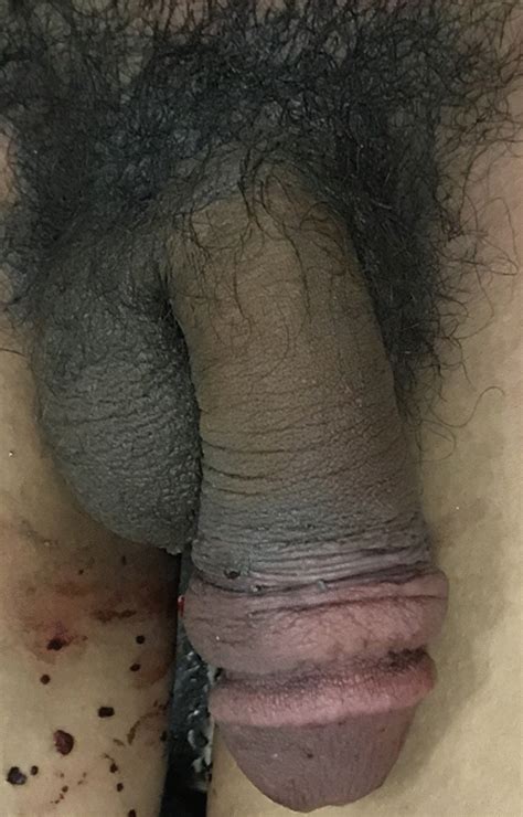 The Penis After Removal Of The Metal Nut Download Scientific Diagram