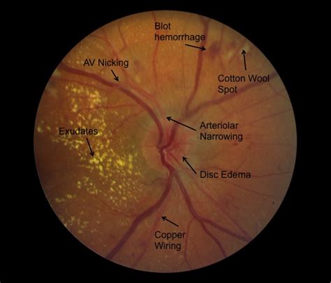 Hypertensive Retinopathy Av Nicking A Review Of Hypertensive