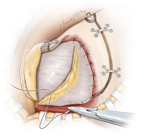 Orbitozygomatic Craniotomy The Neurosurgical Atlas