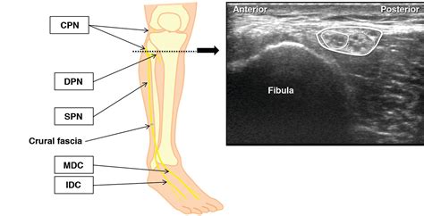Common Fibular Nerve