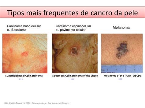Cancro Da Pele Our Skin Never Forgets