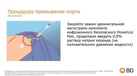 Промывание периферически имплантируемого центрального венозного ...
