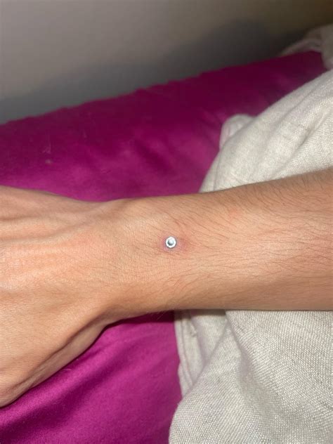 Do I Need To Get My Dermal Removed Rpiercing