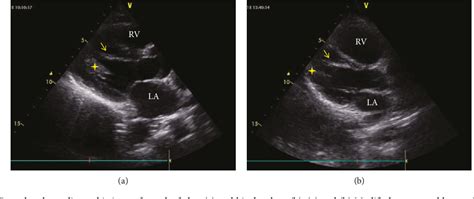 Figure From Resembling Left Ventricular False Tendon In A Father And His Daughter Semantic