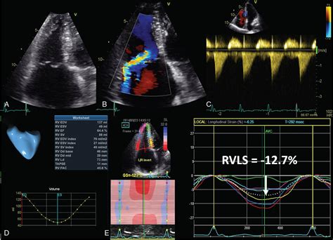 Evaluation Of Right Ventricular Function And Pulmonary Hypertension