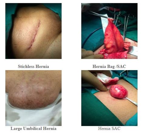 Types Of Hernia