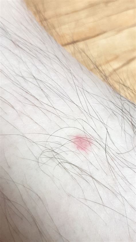다리에 붉은반점 뭔가요 지식in