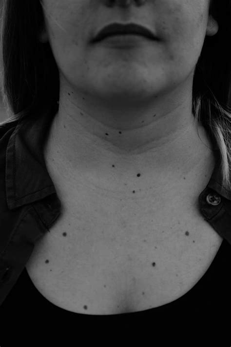Tiroiditis de Hashimoto Clínica Médica de Acupuntura China
